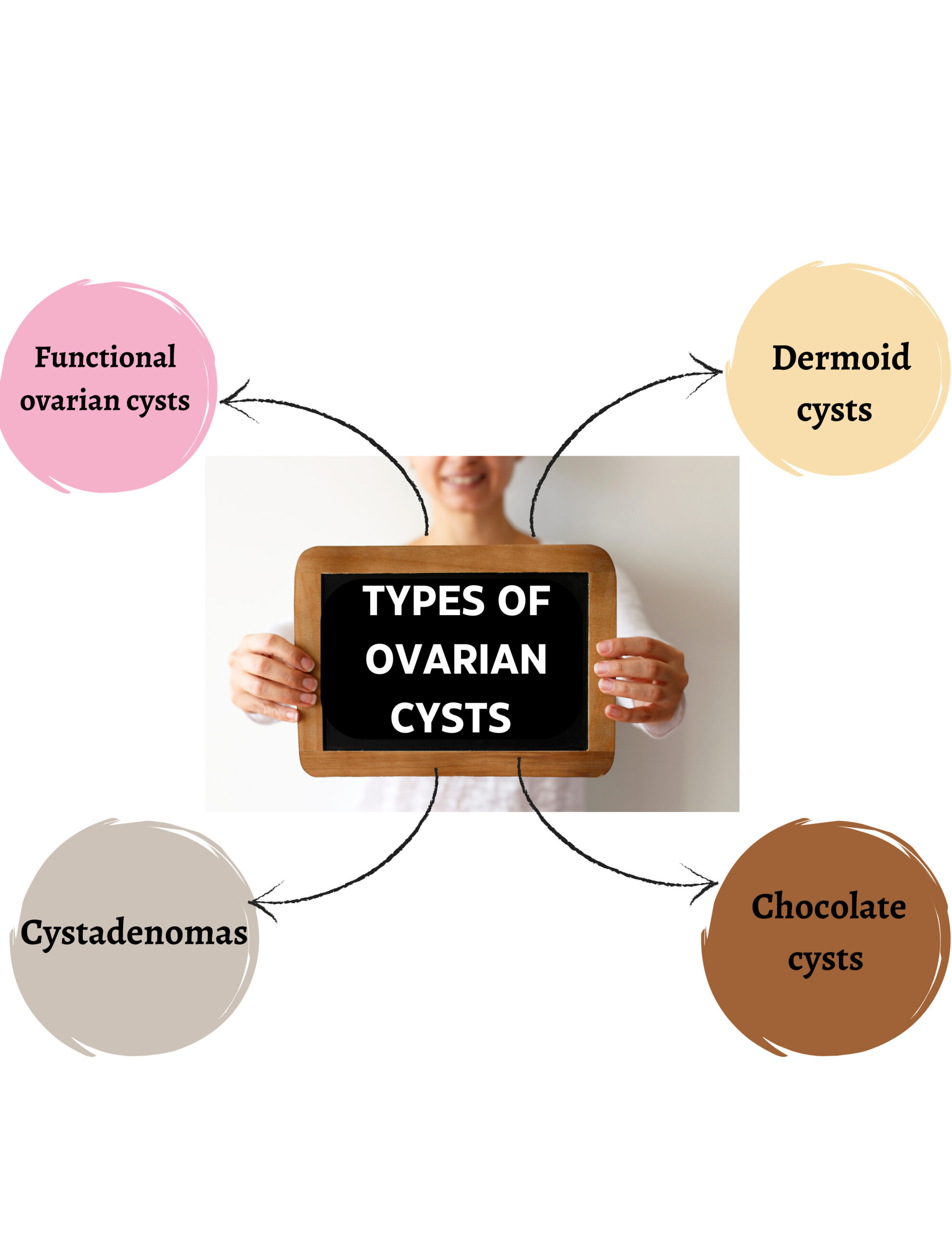 Different Types of Cysts in Ovaries